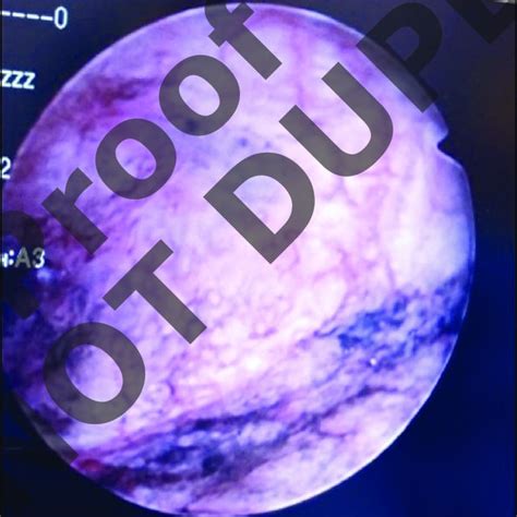 Diffuse Melanosis In A Mucosal Lamina Propria And In B High Grade Download Scientific