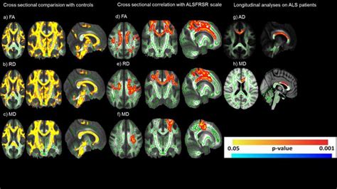 Results Of Tract Based Spatial Statistics Showing Regions With Download Scientific Diagram