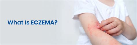 Eczema Types Causes Symptoms And Treatment