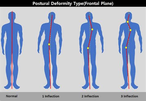 Postural Science Postural Deformity Type Frontal Plane
