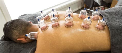 Myofascial Cupping Icareosteopathy