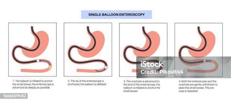 Single Balloon Enteroscopy Stock Illustration Download Image Now
