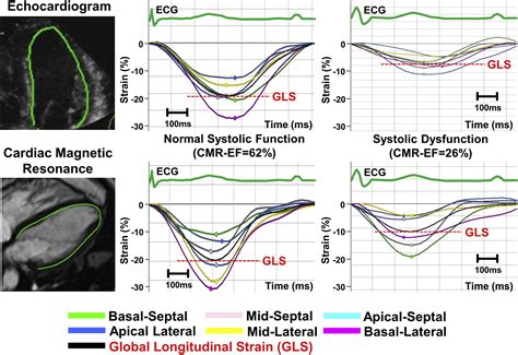 Global Longitudinal Strain And Global Circumferential Strain By Speckle