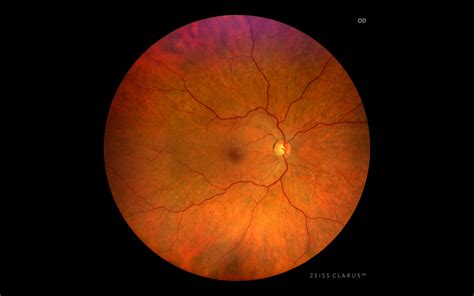 Hypertensive Retinopathy