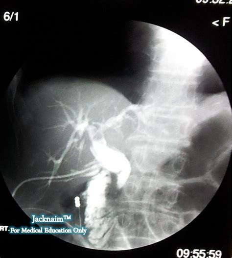 Cholangiogram