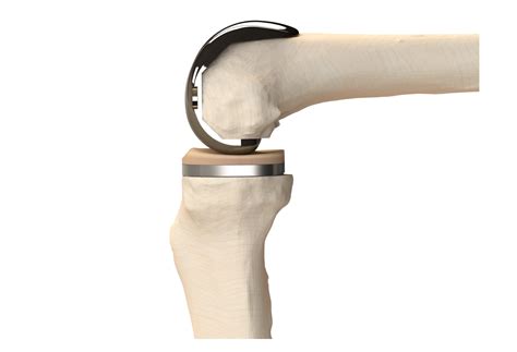 Applied Orthopedic Design Nano Knee Knee Replacement — Aod Applied