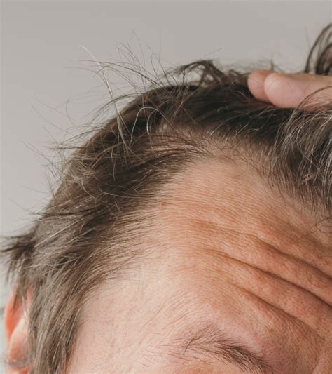 Signs Of Balding At 19