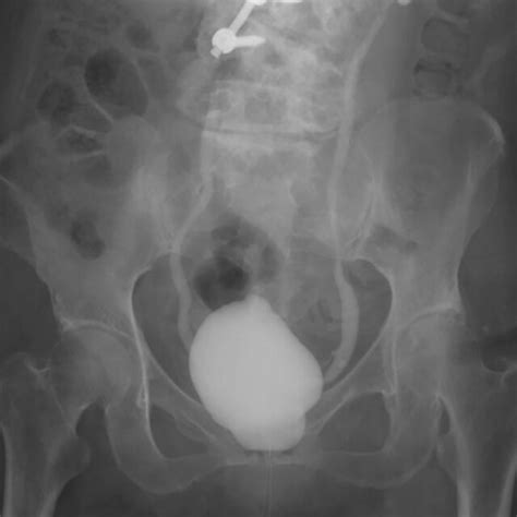 VCUG Performed At Months After BTXA Injection Showed Bilateral Download Scientific Diagram