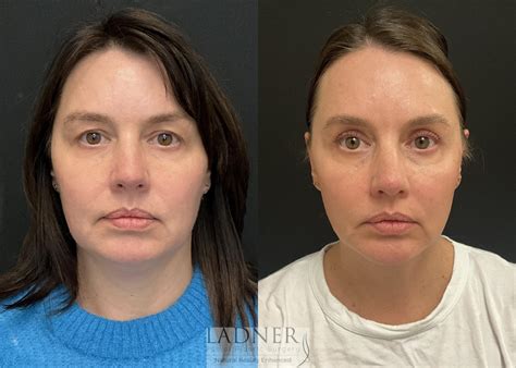 Minimally Invasive Neck Tightening Before And After Pictures Case 228