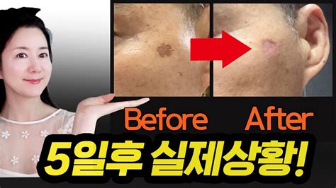 피부과 안가고😮😃 집에서 확 다 뽑아버린 실제사례 검버섯 비립종 잡티는 세안클렌저로 해결해보세요 Youtube