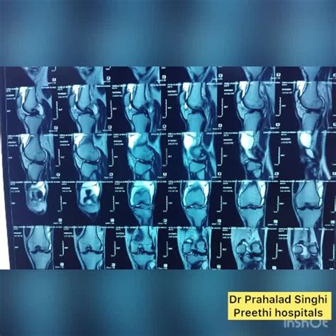 Dr Prahalad Kumar Singhi On Linkedin Arthroscopic Acl Repair Using