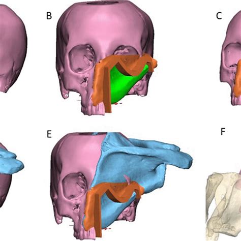 Ad Different Views Of 3d Virtually Designed Maxillary Resection