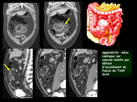 Ppt Pourquoi Le Scanner Dans Lappendicite Aiguë Et Ses Complications