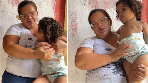 Menina De 3 Anos Nasce Sem O ânus E Vagina Devido à Condição Rara E
