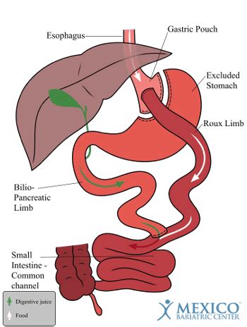 Gastric Sleeve Vs Gastric Bypass Choosing The Right Surgery