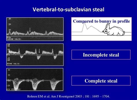 Doppler Ultrasound Of Carotid Arteries