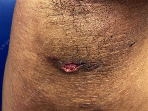 Pyoderma Gangrenosum Stock Image C057 2269 Science Photo Library