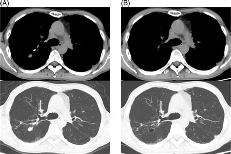Chest Computed Tomography Ct Shows A Lung Nodule And A Calcified Download Scientific Diagram