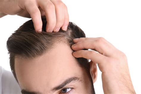 9 Different Types Of Hairlines Low Uneven High Receding And More