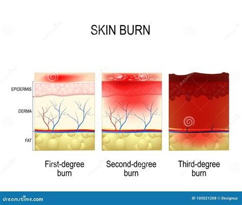 Skin Burn Injury Treatment And Stages Infographic Cartoon Vector