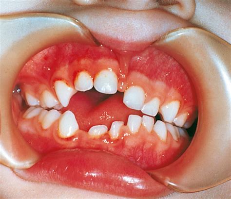 Oral Disorders Clinical Tree