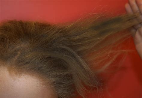 Éste Es El Síndrome Del Cabello Impeinable ¿lo Tienes El Imparcial