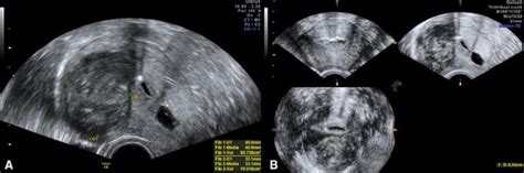 Hysterosalpingo Contrast Sonography Hycosy Lets Make The Point