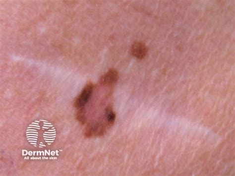 Melanocytic Nevus Vs Melanoma