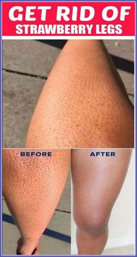 How To Get Rid Of Strawberry Legs Artofit