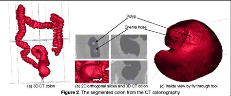 Figure 2 From Automatic Colonic Polyp Detection By The Mapping Using