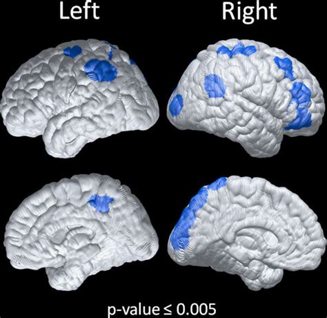 Statistical Cortical Surface Map For Voxel Wise Group Comparison