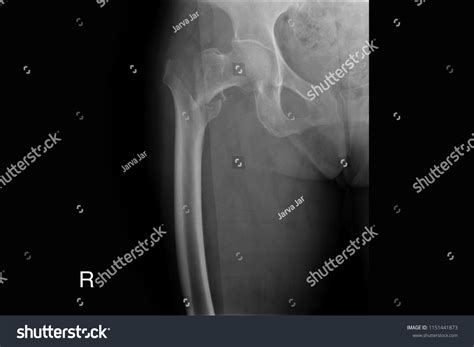Xray Image Show Closed Fracture Right Stock Photo Shutterstock