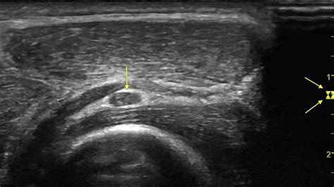 Ultrasound Guided Peripheral Nerve Procedures Physical Medicine And