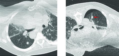 Example Of Likelihood Of Adequacy Score 2 Equivocal A Chest Ct