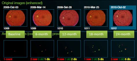 Automatic Microaneurysm Tracking Over Time Color Coding Detecting Each