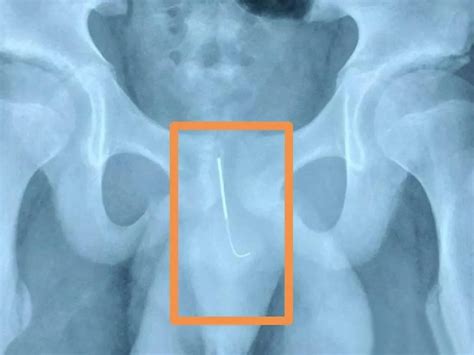 Boy 13 Taken To Hospital After Inserting 10cm Needle Into His Penis