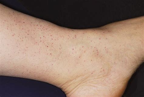 Diffuse Blutungen Bei Akuter Immunthrombozytopenie Zm Online