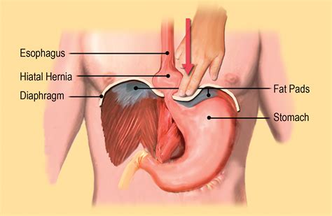 Hernia Hiatal Hernia Symptoms Diagnosis And Treatment Beaufort