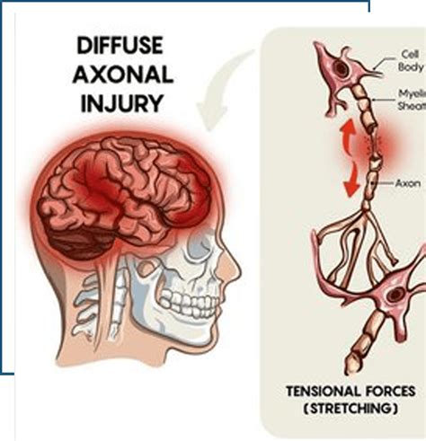 Diffuse Axonal Brain Injury Baxley Maniscalco