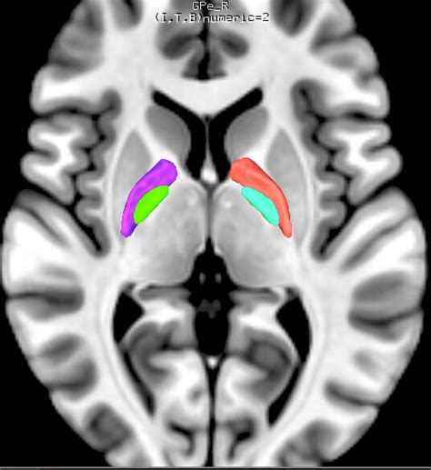 Automatic Segmentation Of Gpi Gpe Neuroimaging Neurostars
