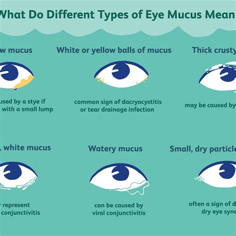 White Stringy Mucus In Eye Eye Discharge Eye Mucus Causes Types