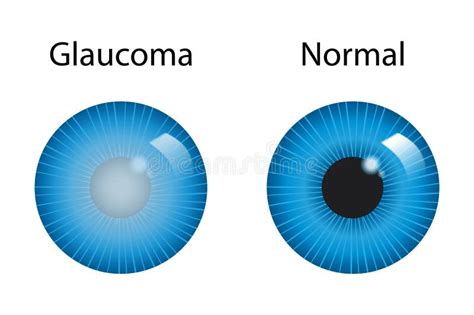 Glaucoma Surgery Concept Procedures To Reduce Intraocular Pressure To