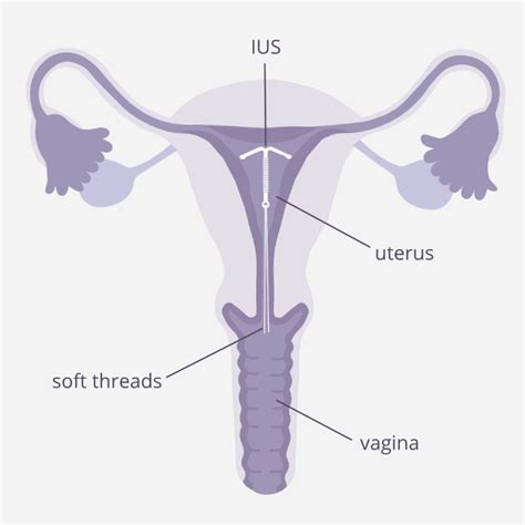 Uterine Coil