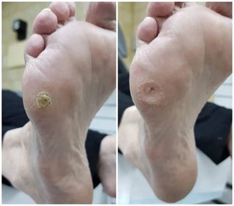 Callous And Corns On Feet Similarities To Blisters