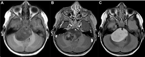 Mri Scan In An Axial 3d T1 Weighted Contrast A 3d T1 Weighted Download Scientific Diagram