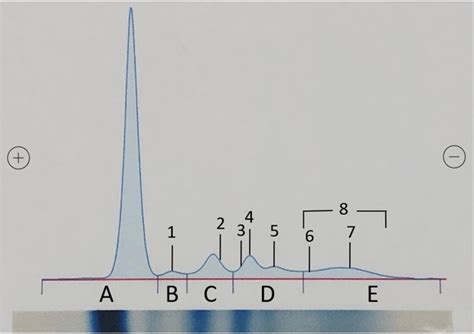Serum Protein Electrophoresis Scan At Erin Patteson Blog