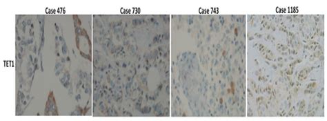 3 Ihc Staining Pattern Of Tet1 Enzyme In Breast Cancer Samples