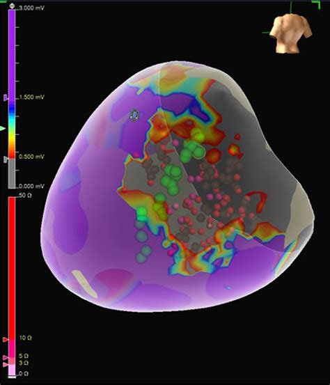 Course Of Left Phrenic Nerve During Epicardial Vt Ablation Epicardial