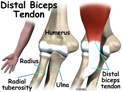 Distal Biceps Tendon Tears Elbow Adam Watson Orthopaedic Surgeon