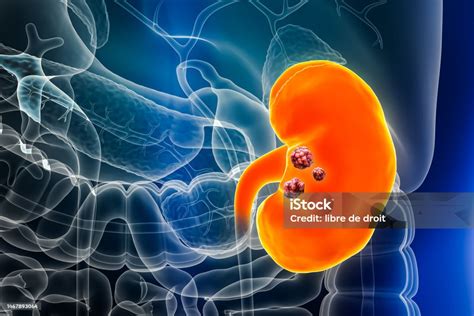 Kanker Panggul Ginjal Atau Ginjal Dengan Organ Dan Tumor Atau Sel